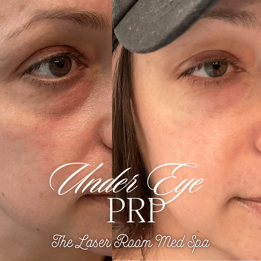 PRP Injections - The Laser Room Med Spa